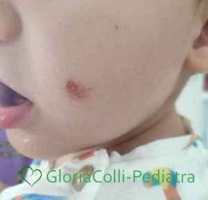 Impétigo. La infección de la piel que vuelve cada verano. - Gloria ...